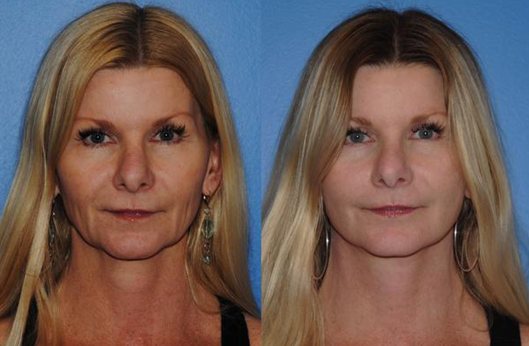 Facelift Surgery - Before & After Photos – Brian P. Dickinson M.D.