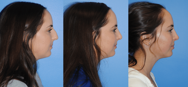 Rhinoplasty Healing Progression - Brian P. Dickinson M.D.