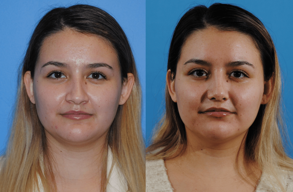 Rhinoplasty and Airway Reconstruction-Tip Definition and Narrowing the ...