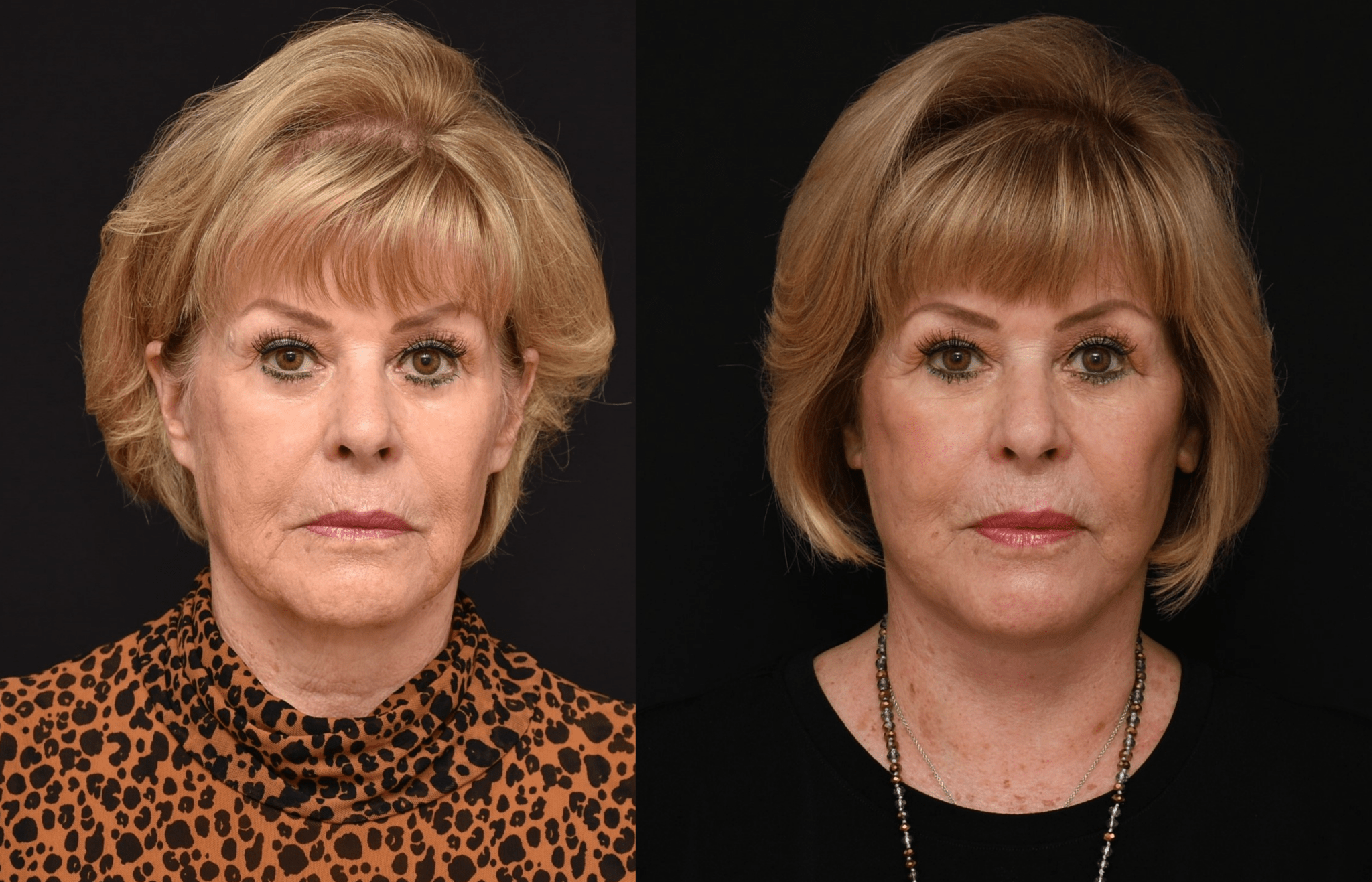 Lower Face and Neck Lift for Facial Rejuvenation - Brian P. Dickinson M.D.